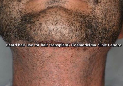 Fue Hair Transplant Clinic Lahore Pakistan Free Checkup Cosmoderma